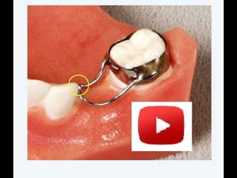 Band and Loop Space Maintainer - YouTube