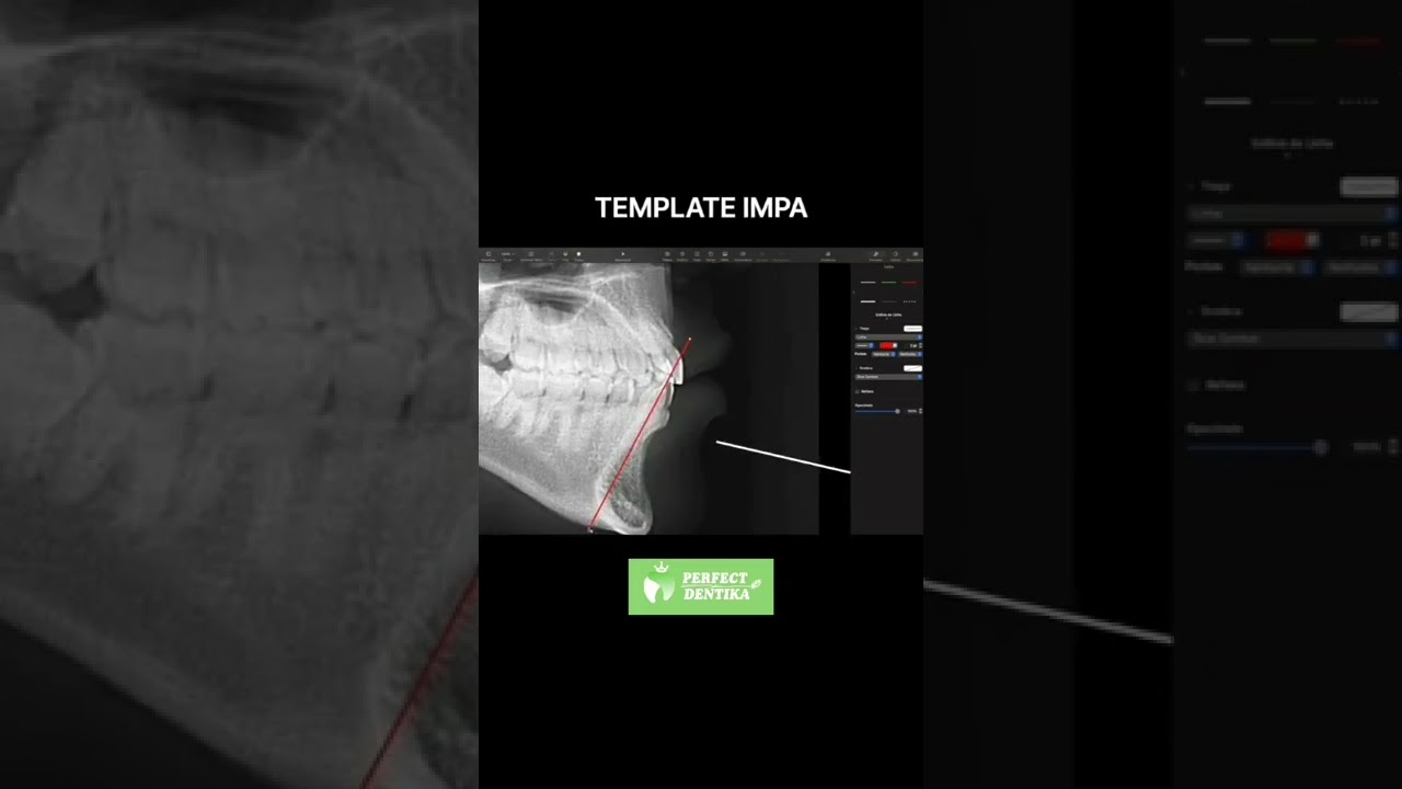 IMPA cefalometría #virale - YouTube