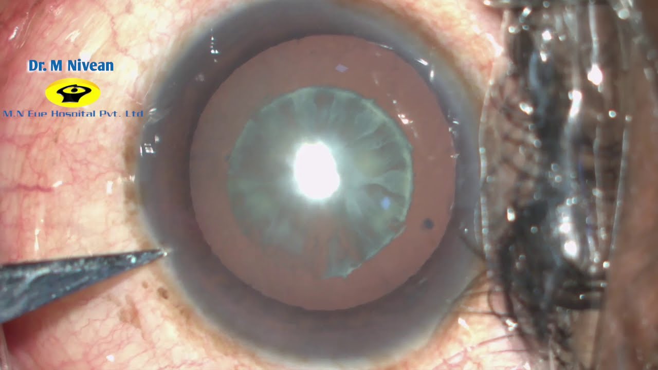 NvN PHACOEMULSIFICATION OF A DEVELOPMENTAL (ZONULAR) CATARACT - YouTube
