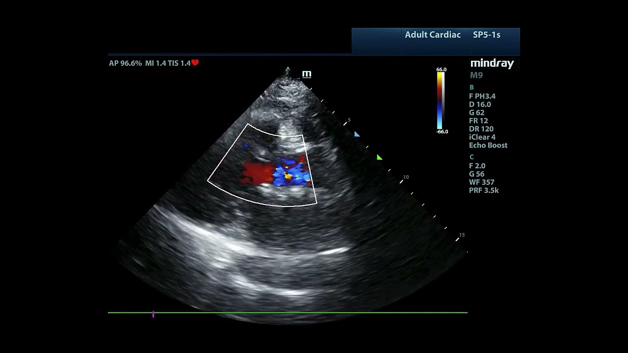 How to...Assess AR by Color Doppler - YouTube
