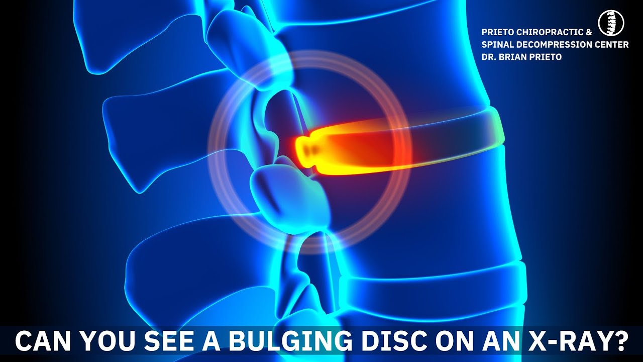 Bulging Disc On An X-Ray Yorba Linda CA - YouTube
