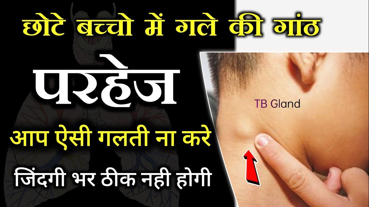 परहेज! छोटे बच्चो की गले की गांठ | Neck cyst | neck lump ?gale ki ganth ...