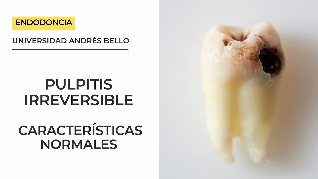 PULPITIS IRREVERSIBLE: Características normales - YouTube