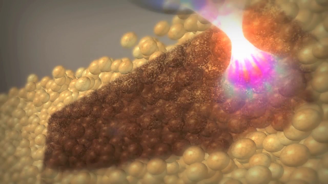 Liposonix Animation Liposonix Treatment - YouTube