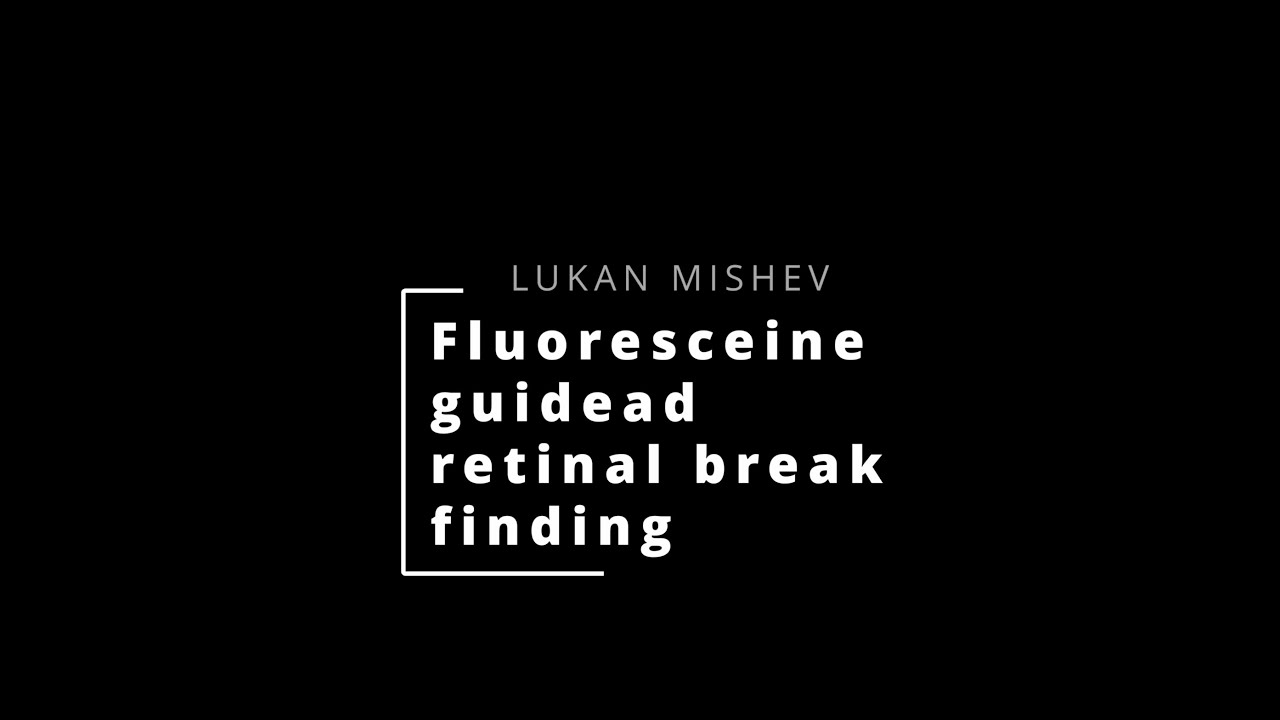 Fluoresceine guided retinal break finding Lukan Mishev - YouTube