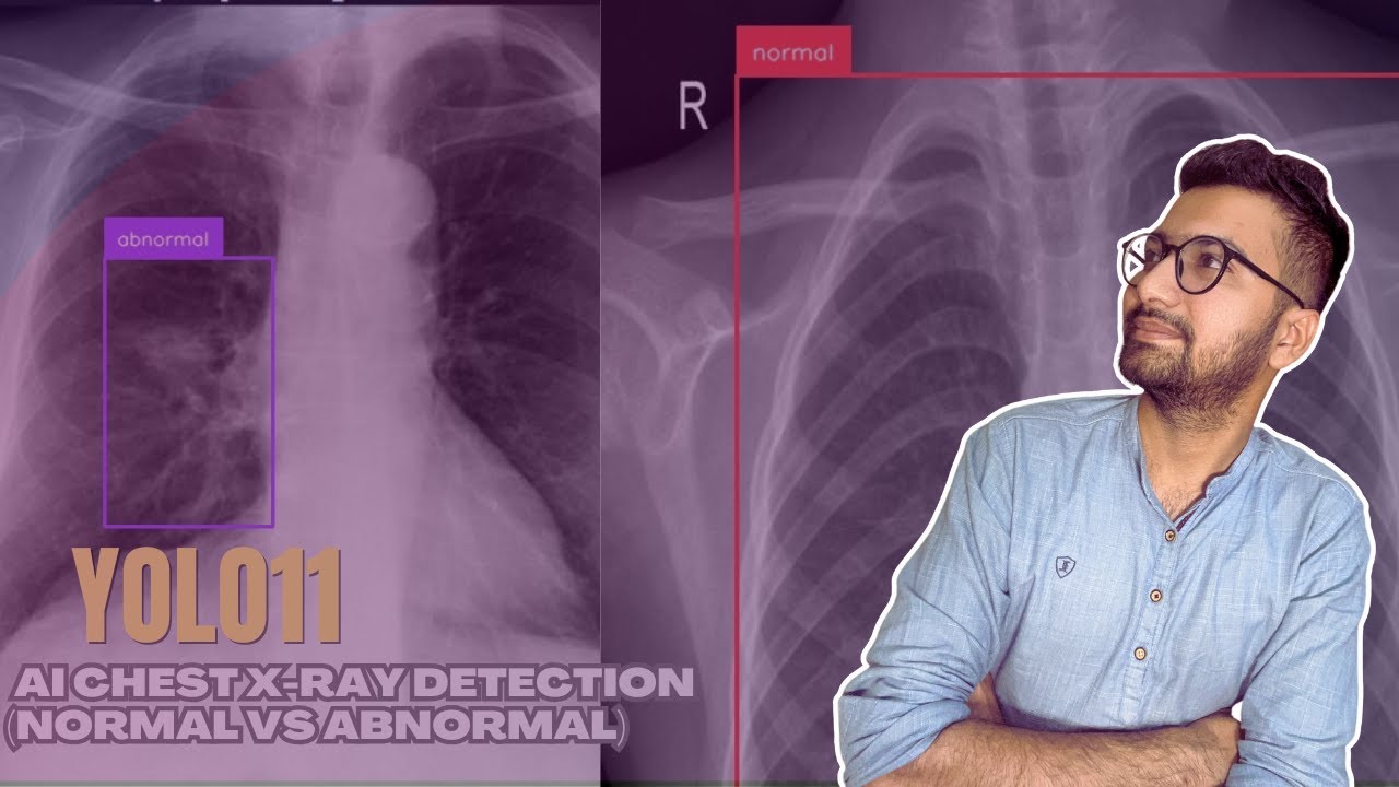 YOLO11: AI Chest X-Ray Detection (Normal vs Abnormal) - YouTube