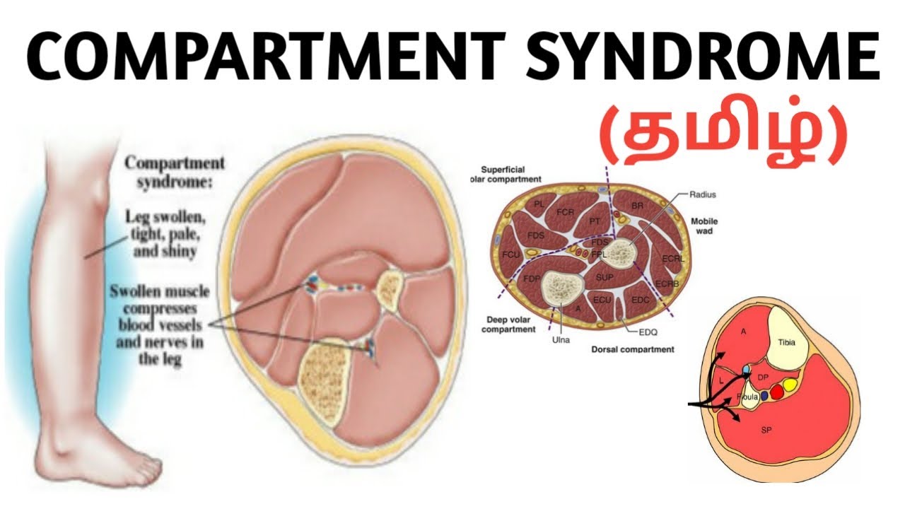 Compartment Syndrome | Causes | Symptoms | Diagnosis | Treatment ...
