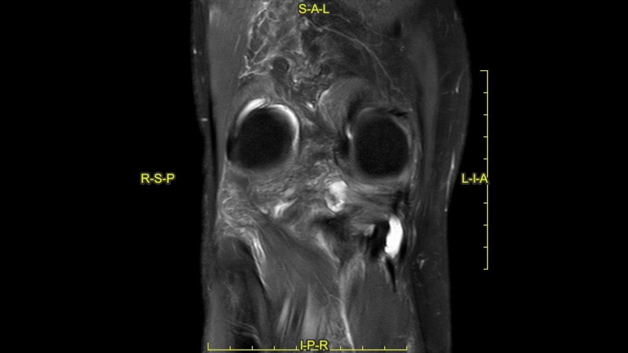 ACL rupture of the knee - complete MRI examination - YouTube