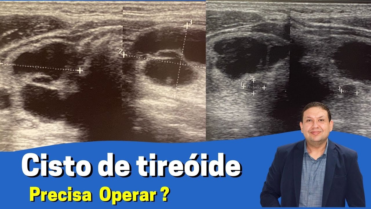Cisto de tireóide é perigoso?? Descobriu um cisto na tireóide no ...