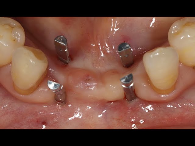 Pin By Indianmedtrip On Dental Implant Surgery Dental Reasons To Get