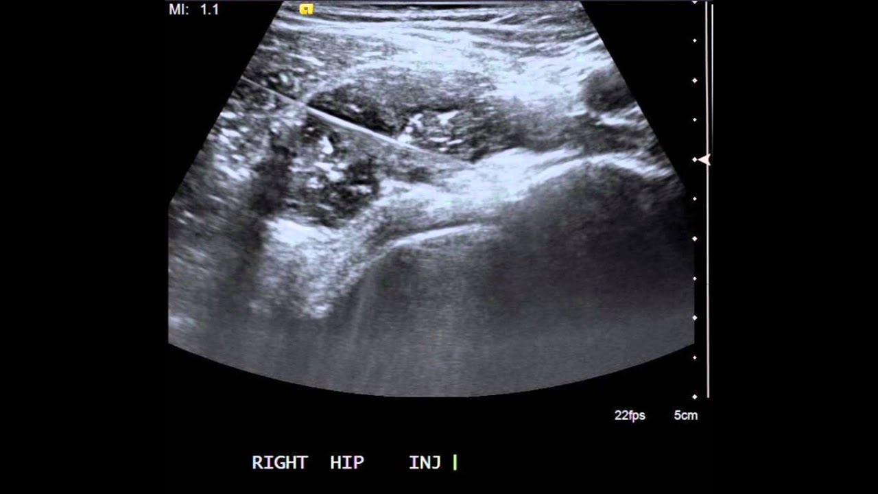 Ultrasound Guided Psoas Bursa Injection Youtube Greater Trochanteric