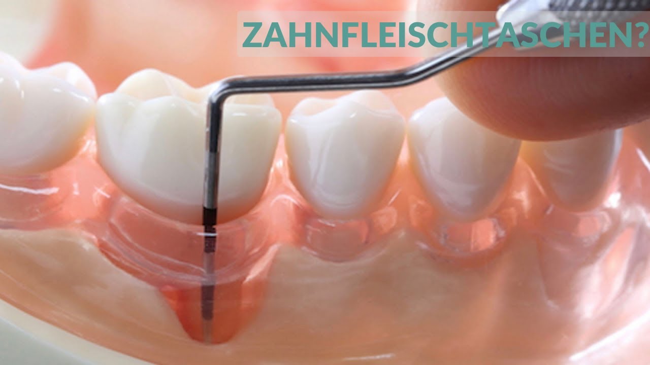 Parodontitis: Die wichtigsten Informationen zur Behandlung - YouTube