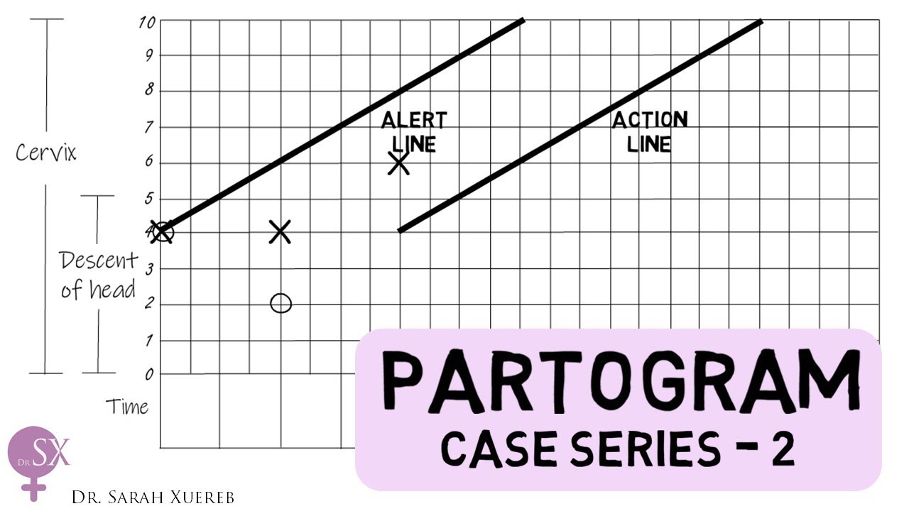 Partogram - Case Series 2 - YouTube