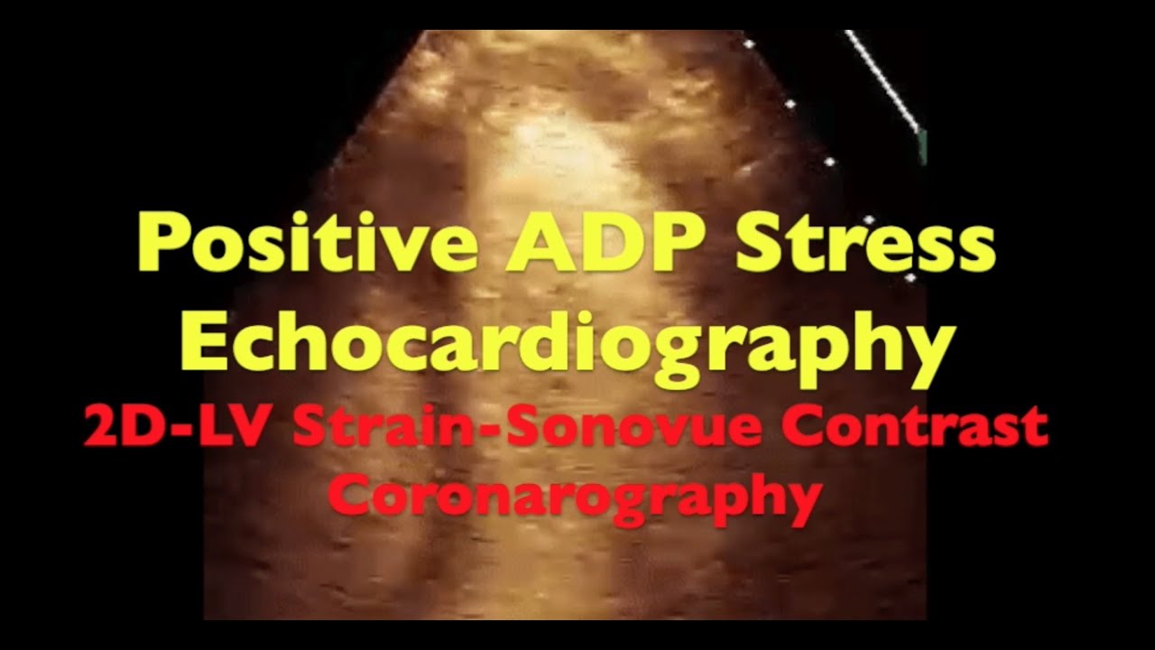 Positive ADP Stress Echo :2D LV Strain Sonovue Contrast Coronarography ...