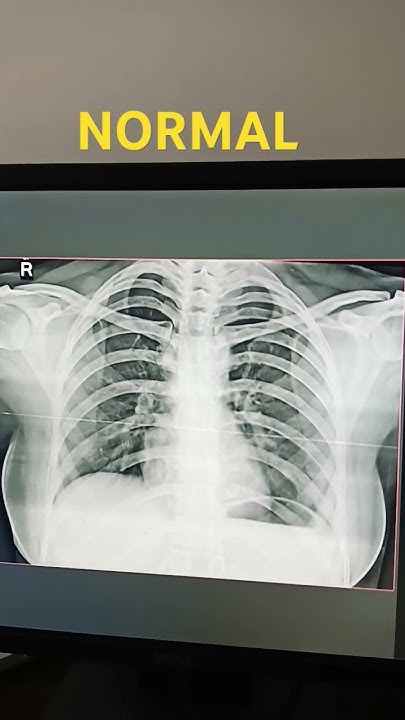XRAY CHEST PA NORMAL ZONE - YouTube