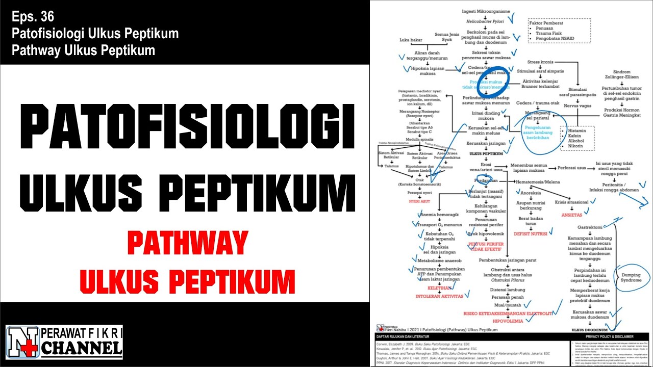 Patofisiologi Ulkus Peptikum I Pathway Ulkus Peptikum I Ulkus Duodenum ...