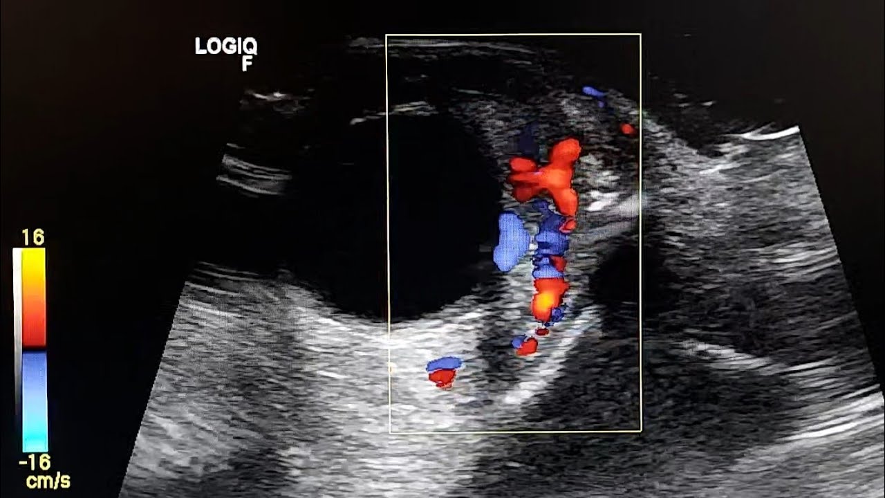 ocular ultrasound showing haemangioma of the orbit - YouTube