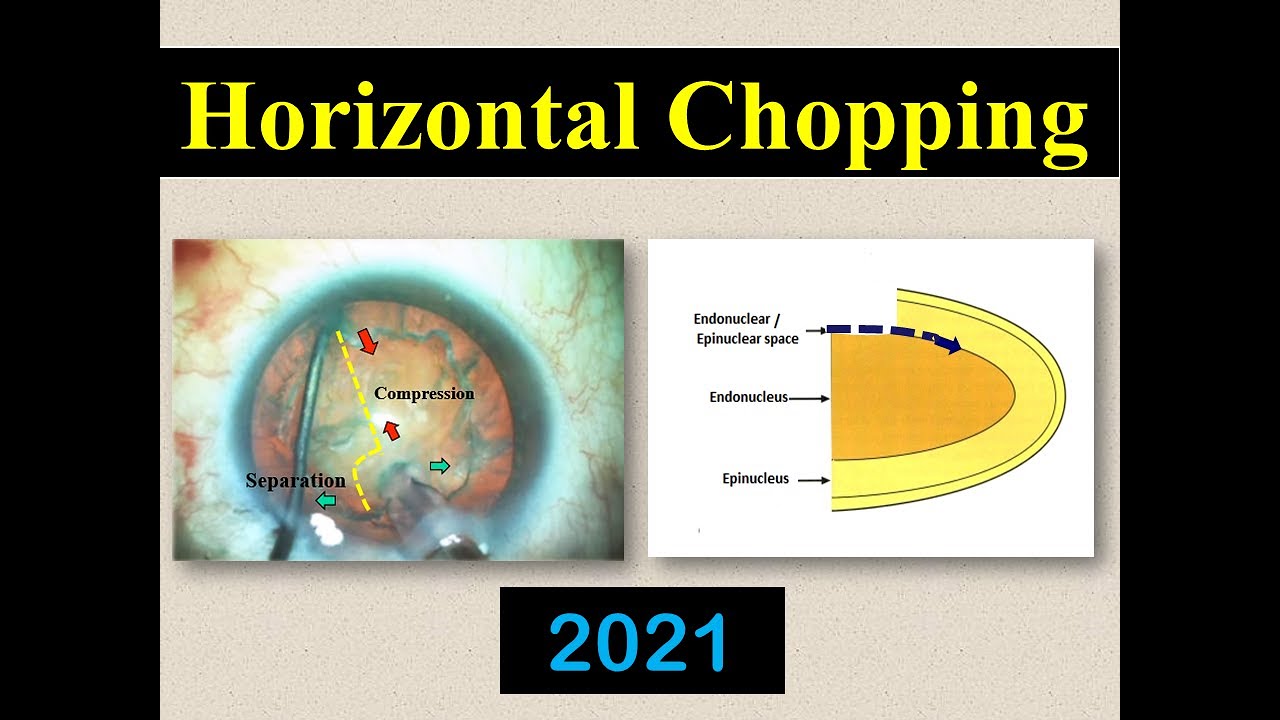 Horizontal phaco chopping (basic phaco ) # 008 - YouTube