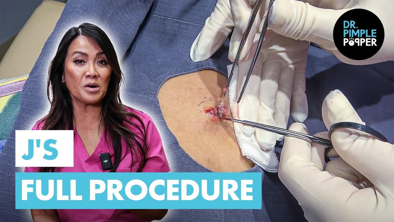 "Thank You for Not Removing this Cyst Yourself": The Full Procedure ...