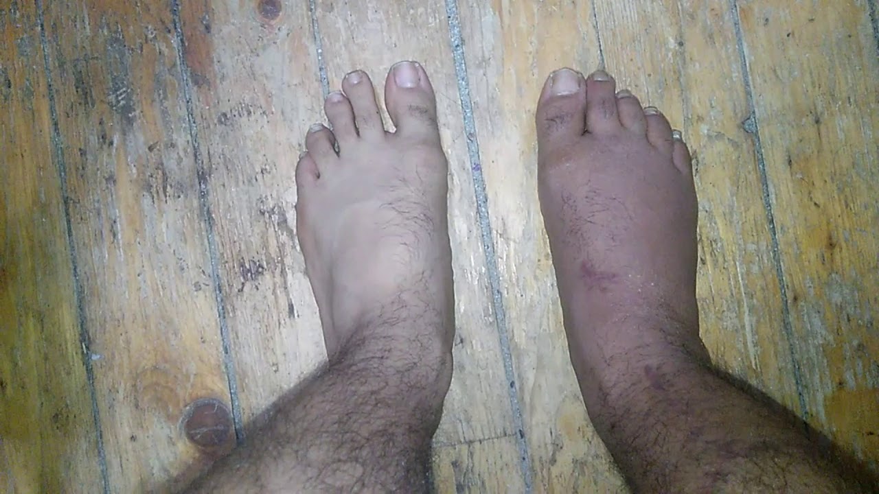 Recovery for Severed Ankle Tendons (EHL, EDL and Tibialis Anterior ...