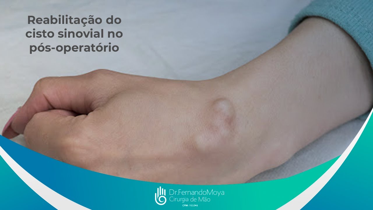 Reabilitação do cisto sinovial no pós-operatório | Dr. Fernando Moya ...