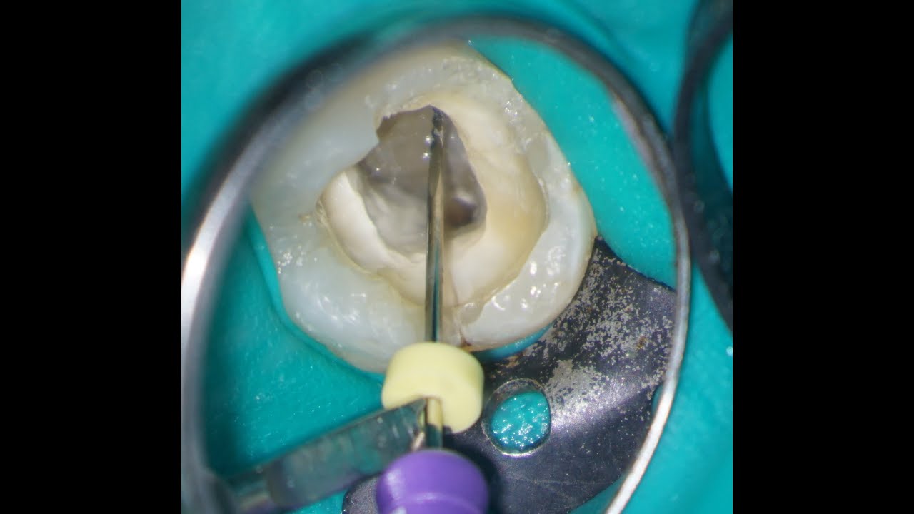 Locating difficult canals during RCT UR6 - YouTube