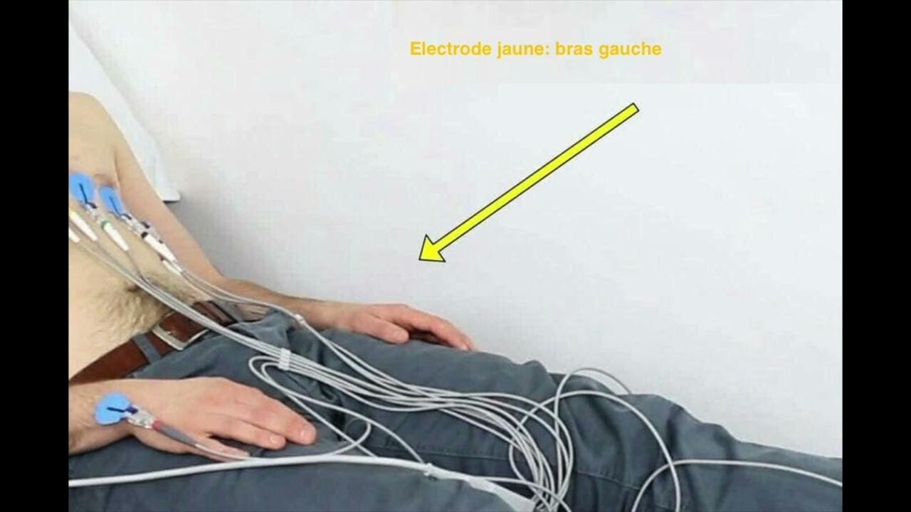 Comment réaliser un ECG 12 dérivations - YouTube