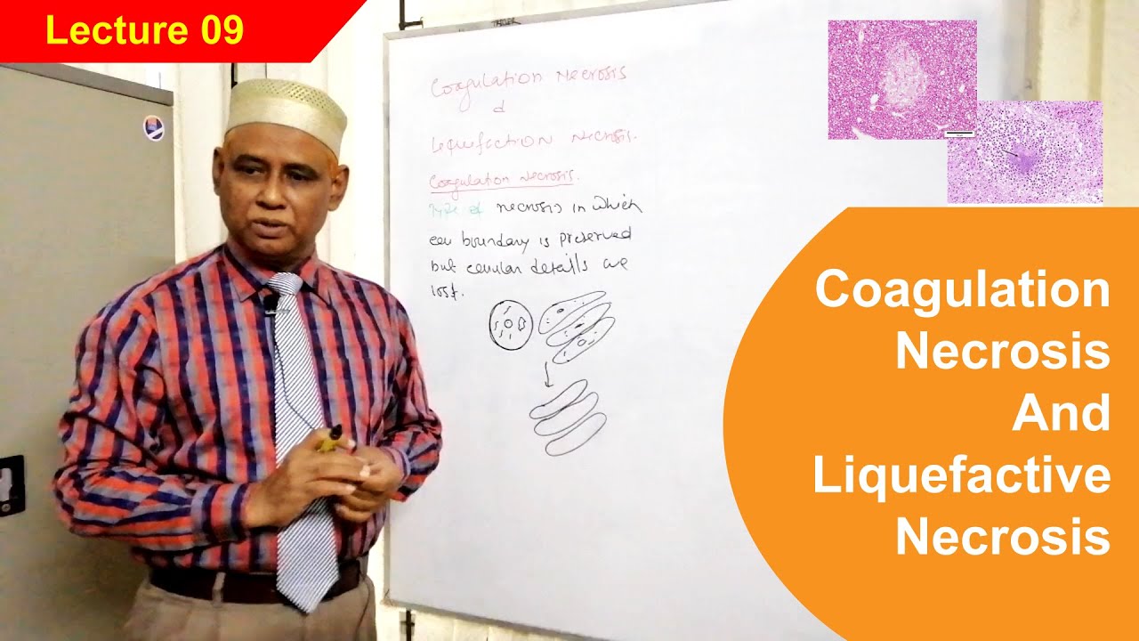 General Pathology: Lecture 9 | Coagulation Necrosis & Liquefactive ...