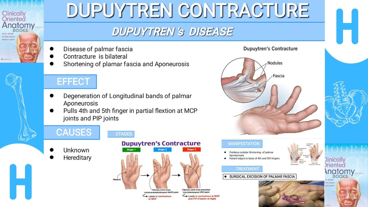 Dupuytren's Contracture-Full description #Dupuytrendisease - YouTube