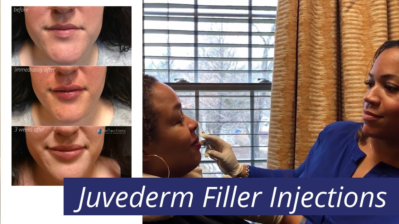 Juvederm Filler Injections [Beyond Lip Filler] with Dr. Joni Jefferson ...