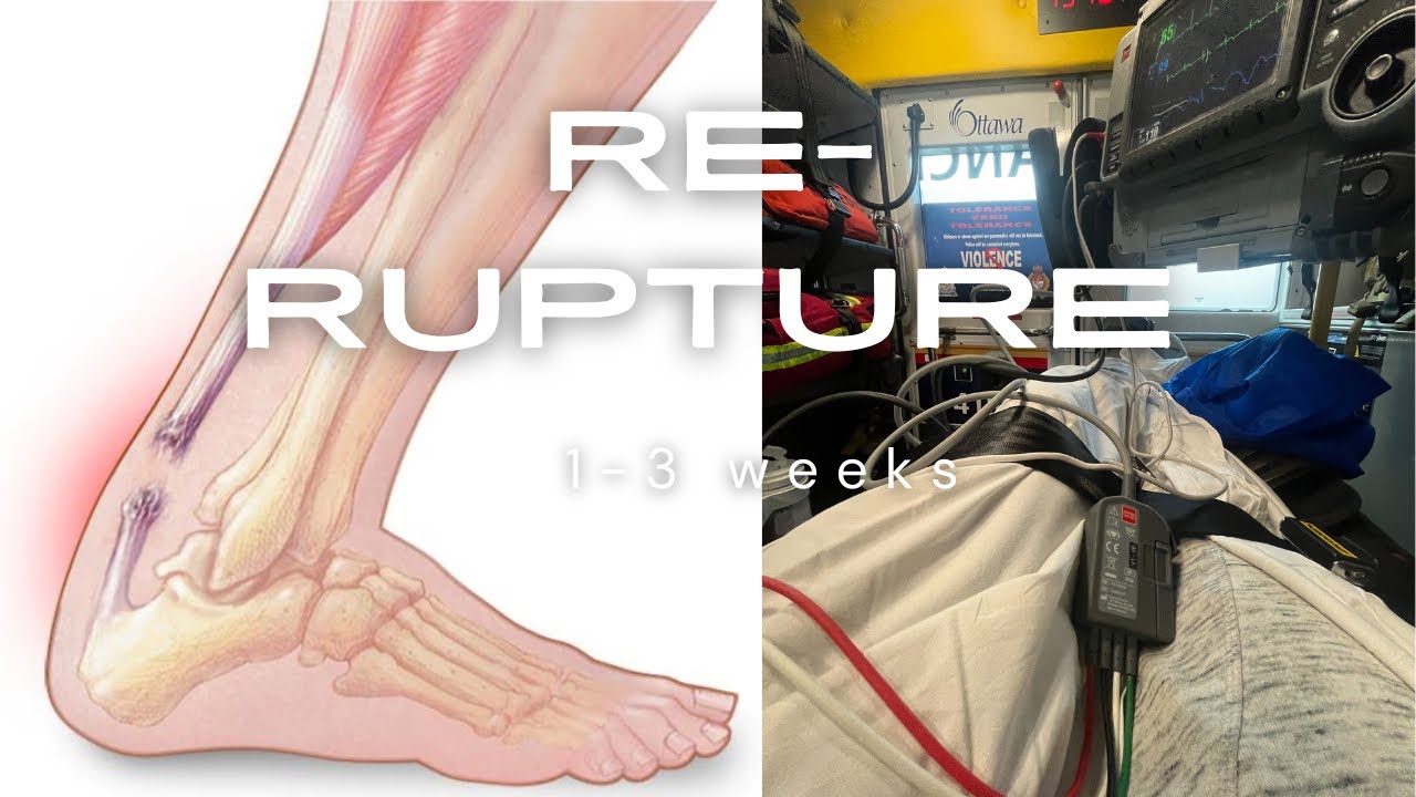 re-rupture-achilles-tendon-1-3-weeks-post-surgery-youtube