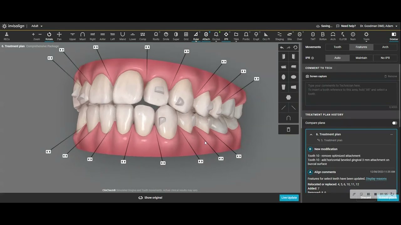 Invisalign Optimized Attachments vs. Larger Attachments - YouTube