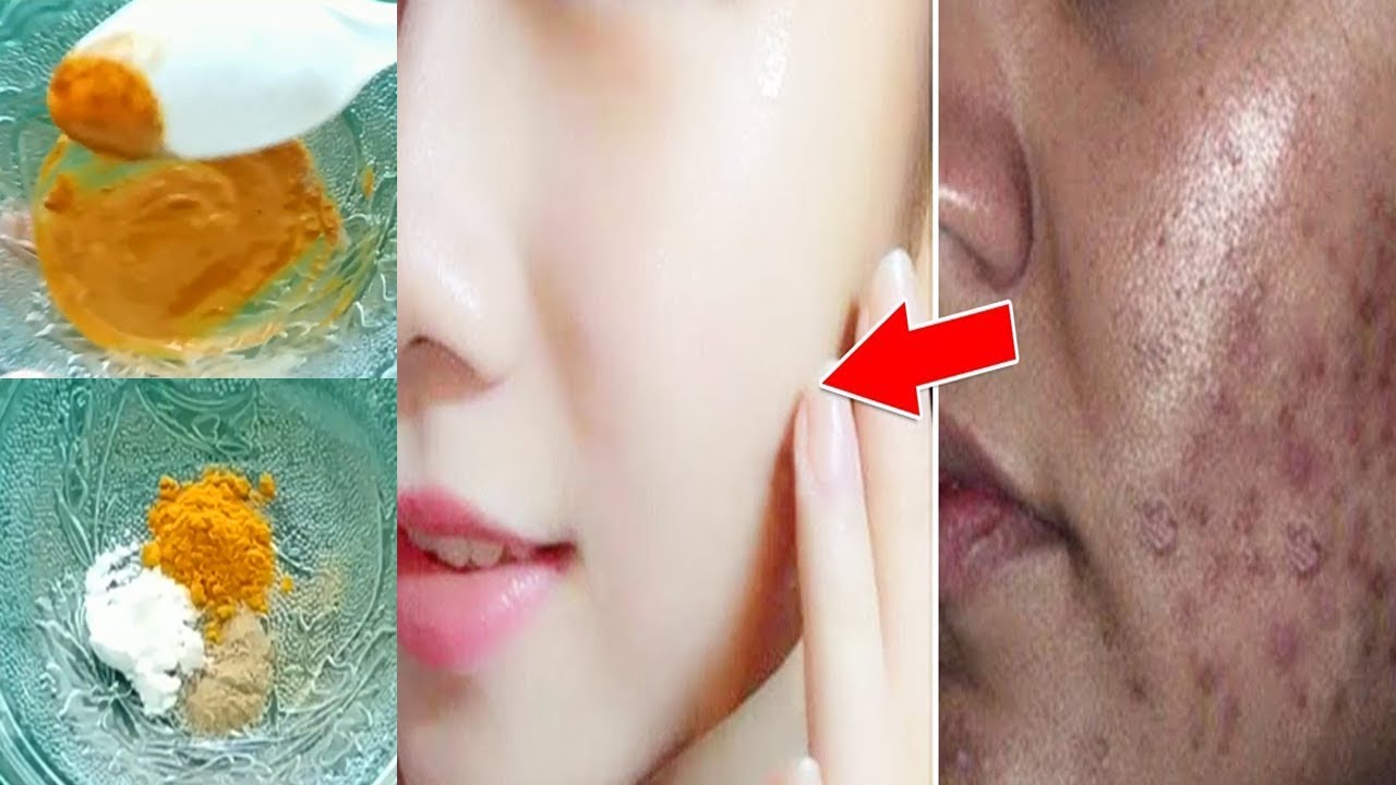 How To Do Facials At Home For Acne Scars Special Skin Care For Acne Scars At Home YouTube how-to-do-facials-at-home-for-acne-scars-special-skin-care-for-acne-scars-at-home-youtube