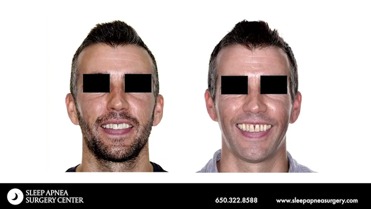 World Sleep 2019 | Dr. Kasey Li | Maxillary Expansion Endoscopic ...