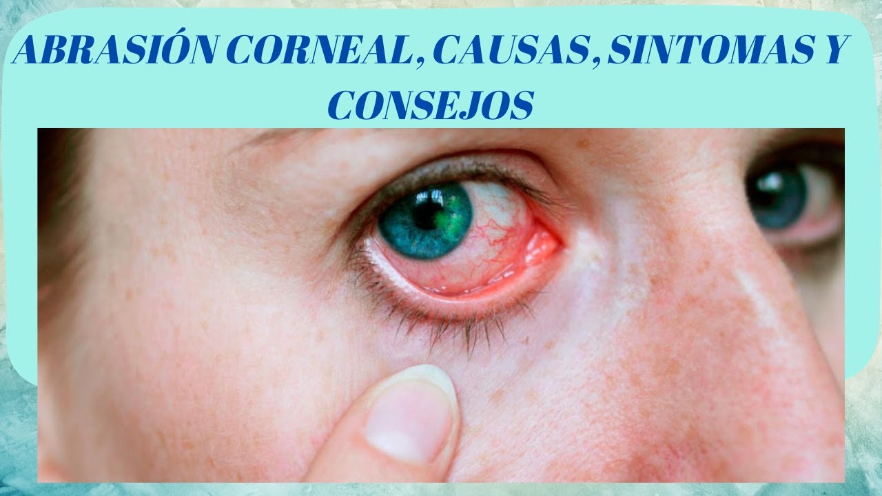 Que es una Abrasión Corneal, Causas, Síntomas y Consejos - YouTube