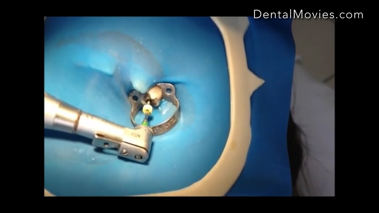 Endodontic retreatment - The access - YouTube