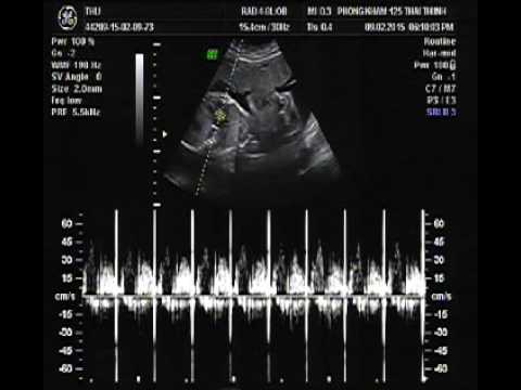 Ultrasound 30th weeks Pregnancy - YouTube