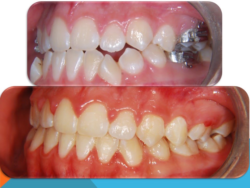 Amazing Class Iii Correction Orthodontics Youtube