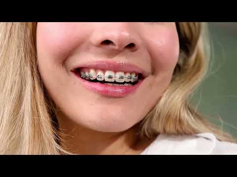 Fake Braces | Retainer with Brackets