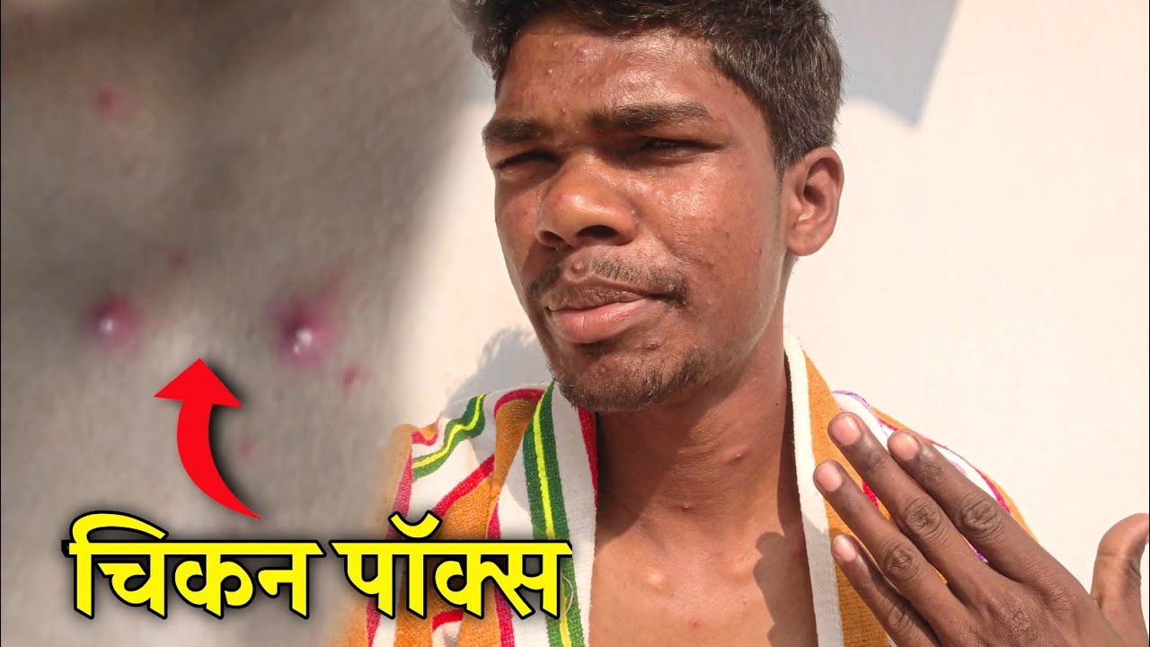चिकन पॉक्स (चेचक) की बीमारी || Chicken Pox || chechak || Badi Mata hona ...