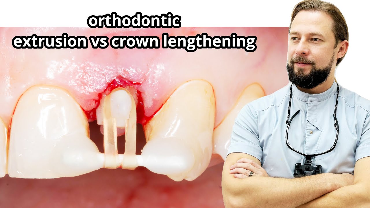 WOW orthodontic extrusion vs crown lengthening vs Forced Eruption # ...