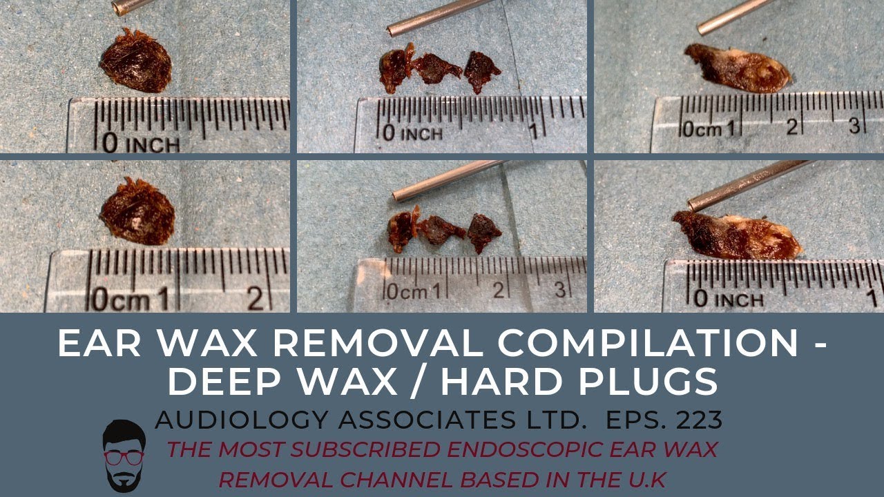 EAR WAX REMOVAL COMPILATION - DEEP WAX/HARD PLUGS - EP223 - YouTube