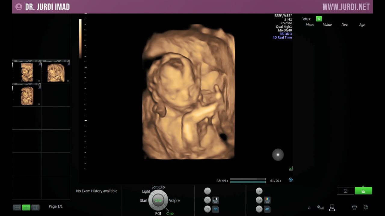 Dr. Jurdi Imad, 4D ultrahang vizsgálat, 18. hét - YouTube