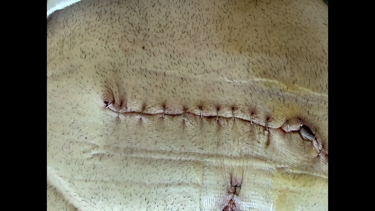 Getting staples out after surgery - YouTube