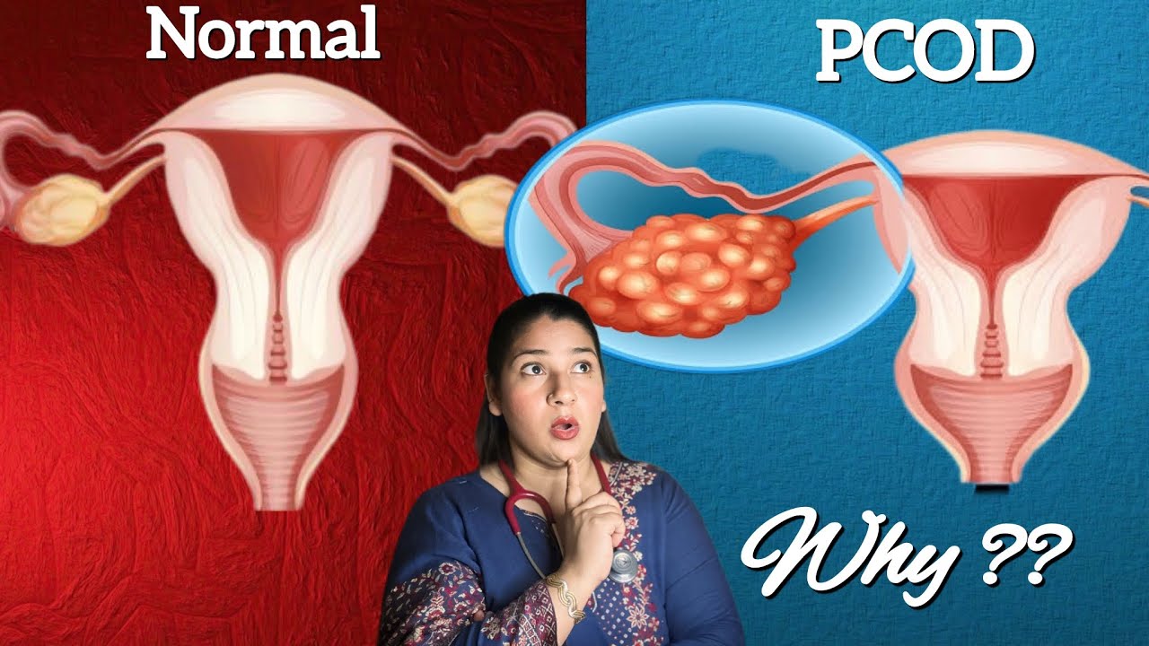 Pcod का क्या कारण होता है।Pcod problem solution in Hindi| - YouTube