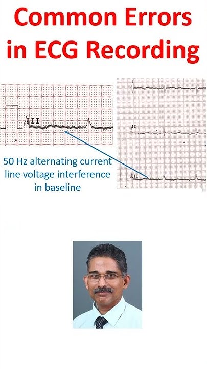 Common Errors in ECG Recording - YouTube