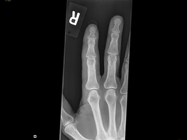 Avulsion Fracture Hand Xray