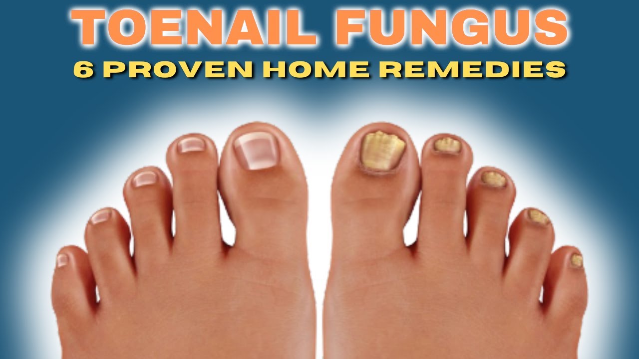 Revitalize Your Toenails: 6 Proven Home Remedies for Toenail Fungus ...