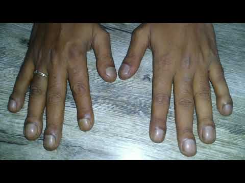 Digital Clubbing Schamroth sign - YouTube