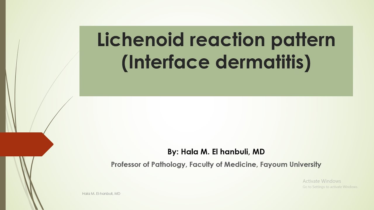 Lichenoid reaction - YouTube